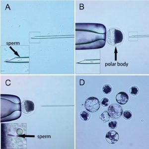 What is Intracytoplasmic Sperm Injection (ICSI)? Process and Risk