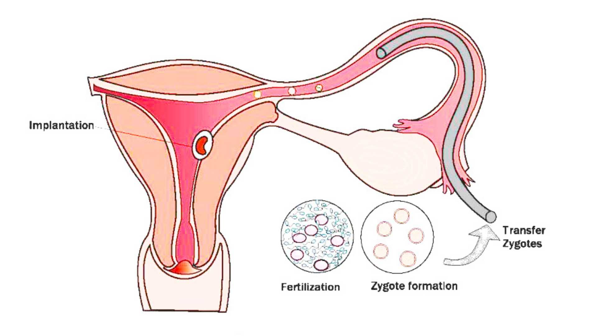 Types Of Ivf And Their Procedures Aastha Fertility Center